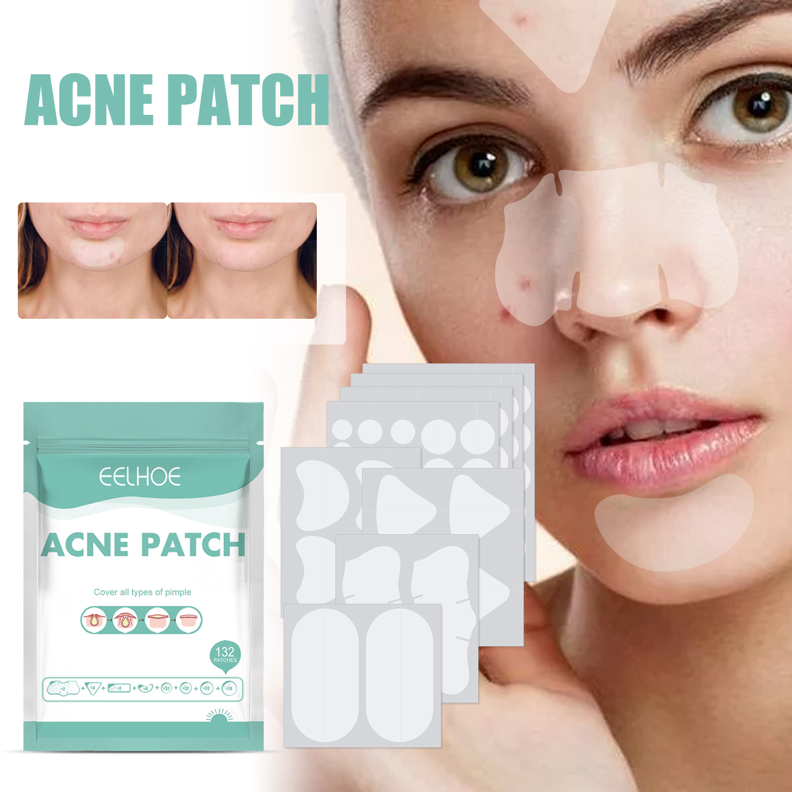 EELHOE Acne Relief Mask Patch Is A Gentle, Non-irritating Acne Mask ...